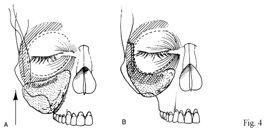 Cosmetic Eyelid Surgery