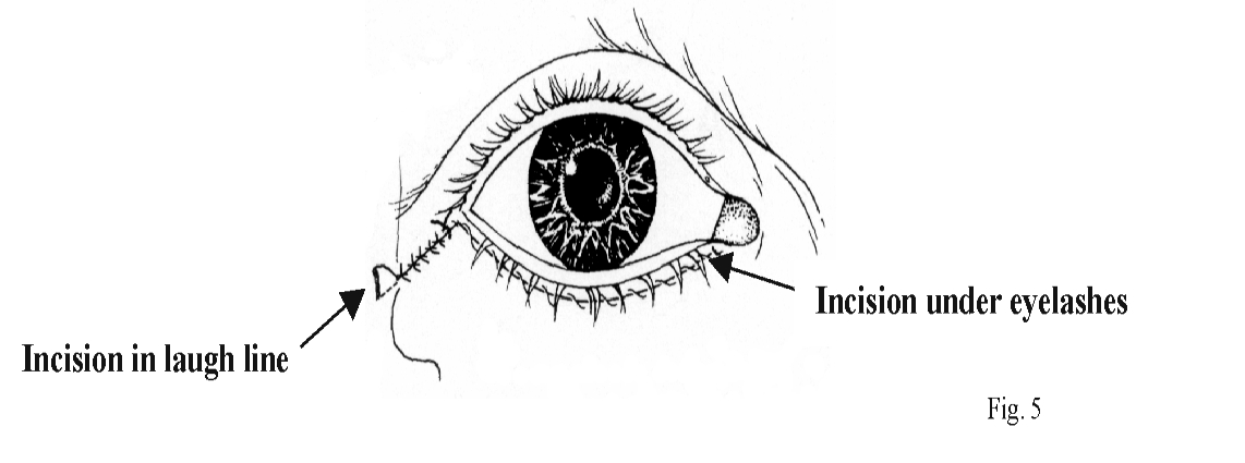Cosmetic Eyelid Surgery